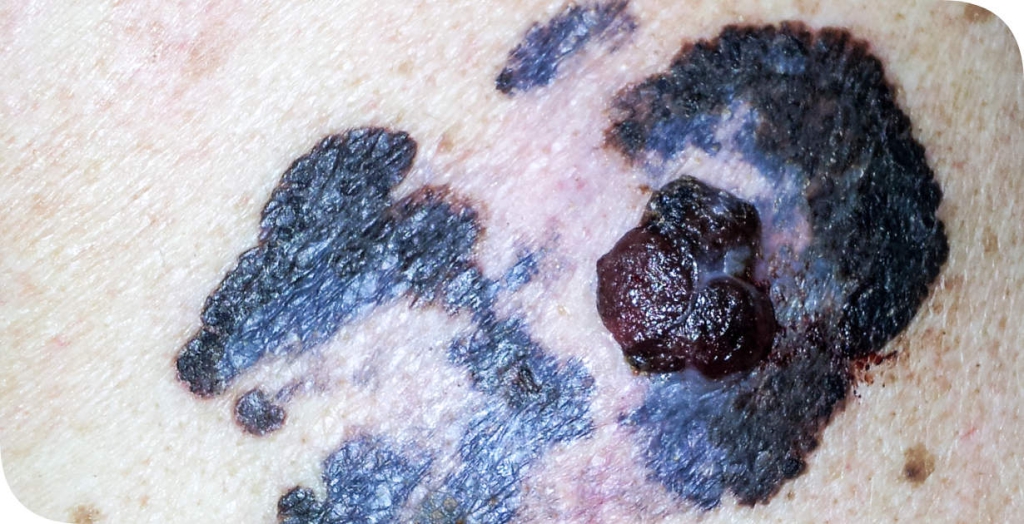 Dermatoskopia – Badanie Znamion Skórnych – Grupa Galmedic